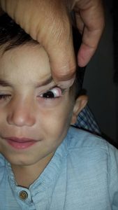 Dermolipoma de la órbita o lipodermoide conjuntival - Consulta de ...